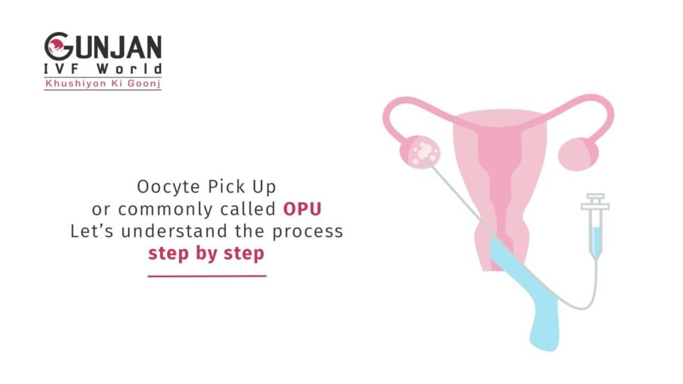 OPU Pickup - How is it done - Gunjan IVF World
